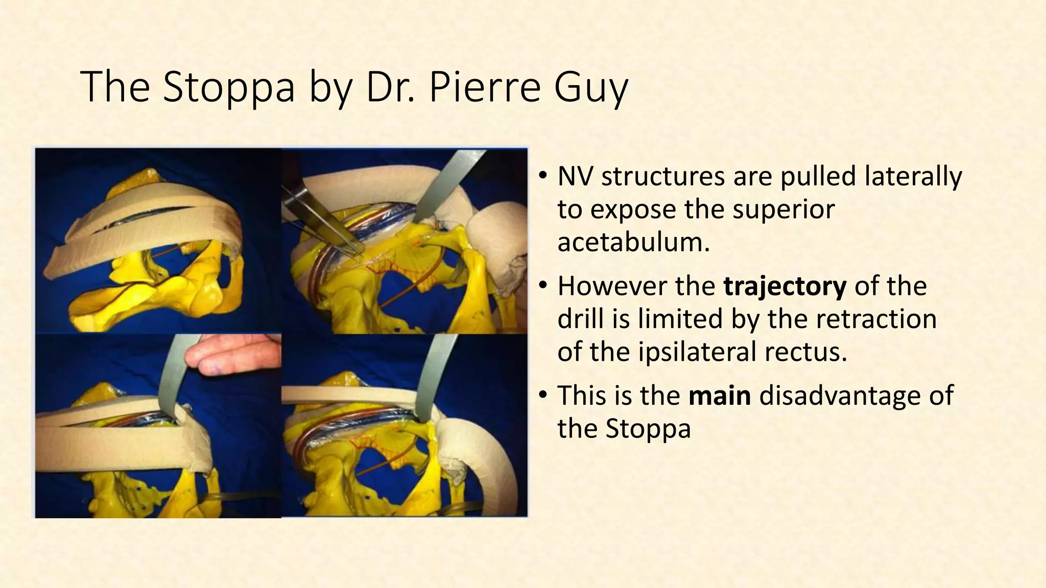 A new anterior acetabular approach | PPTX
