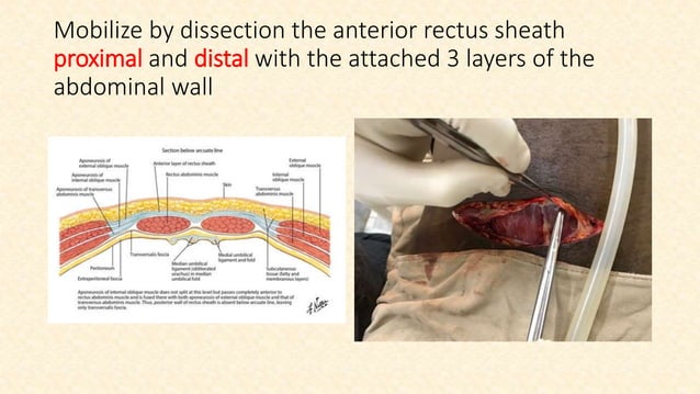 A new anterior acetabular approach | PPTX