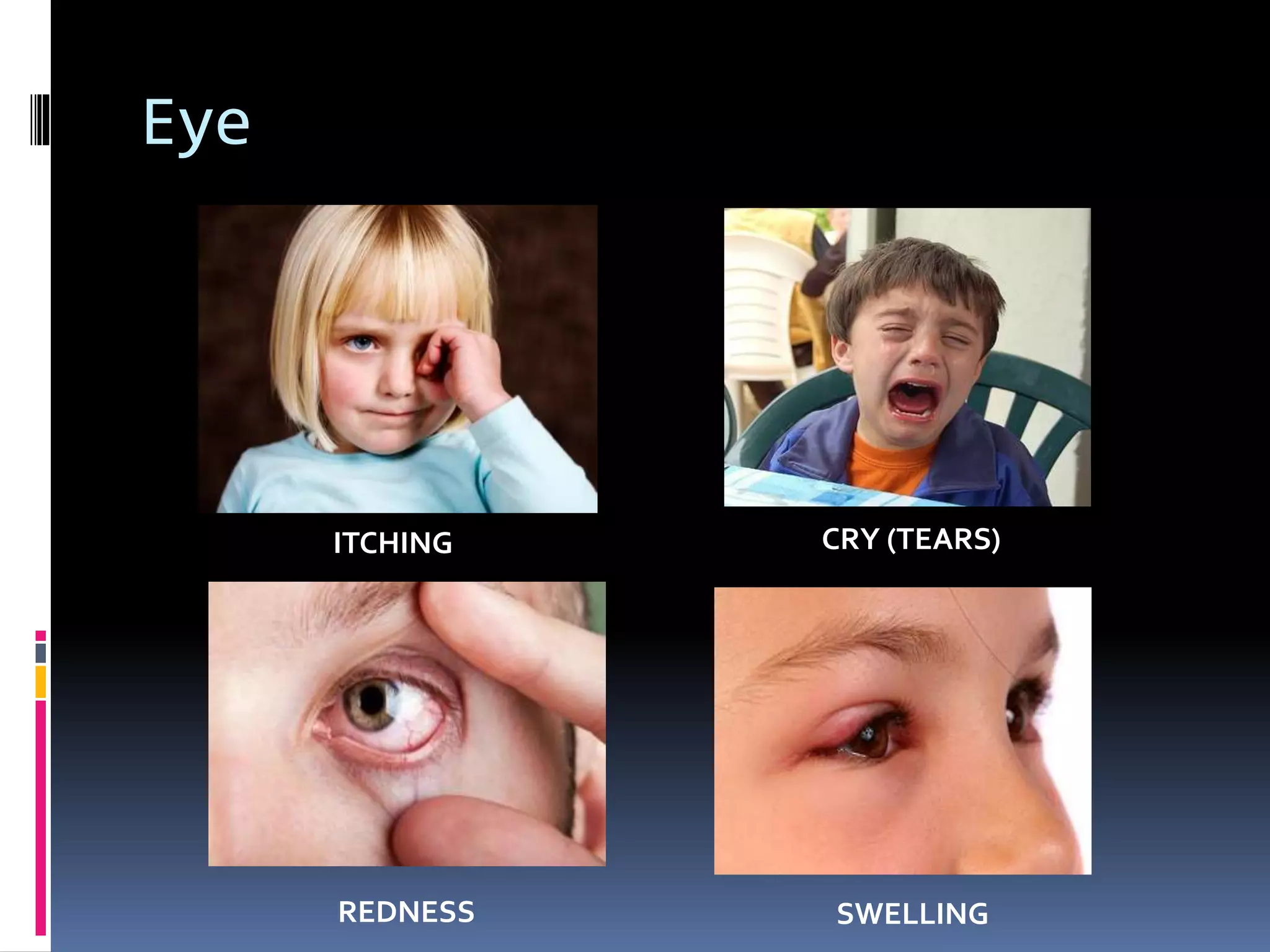 PEDIATRIC ANAPHYLAXIS | PPTX