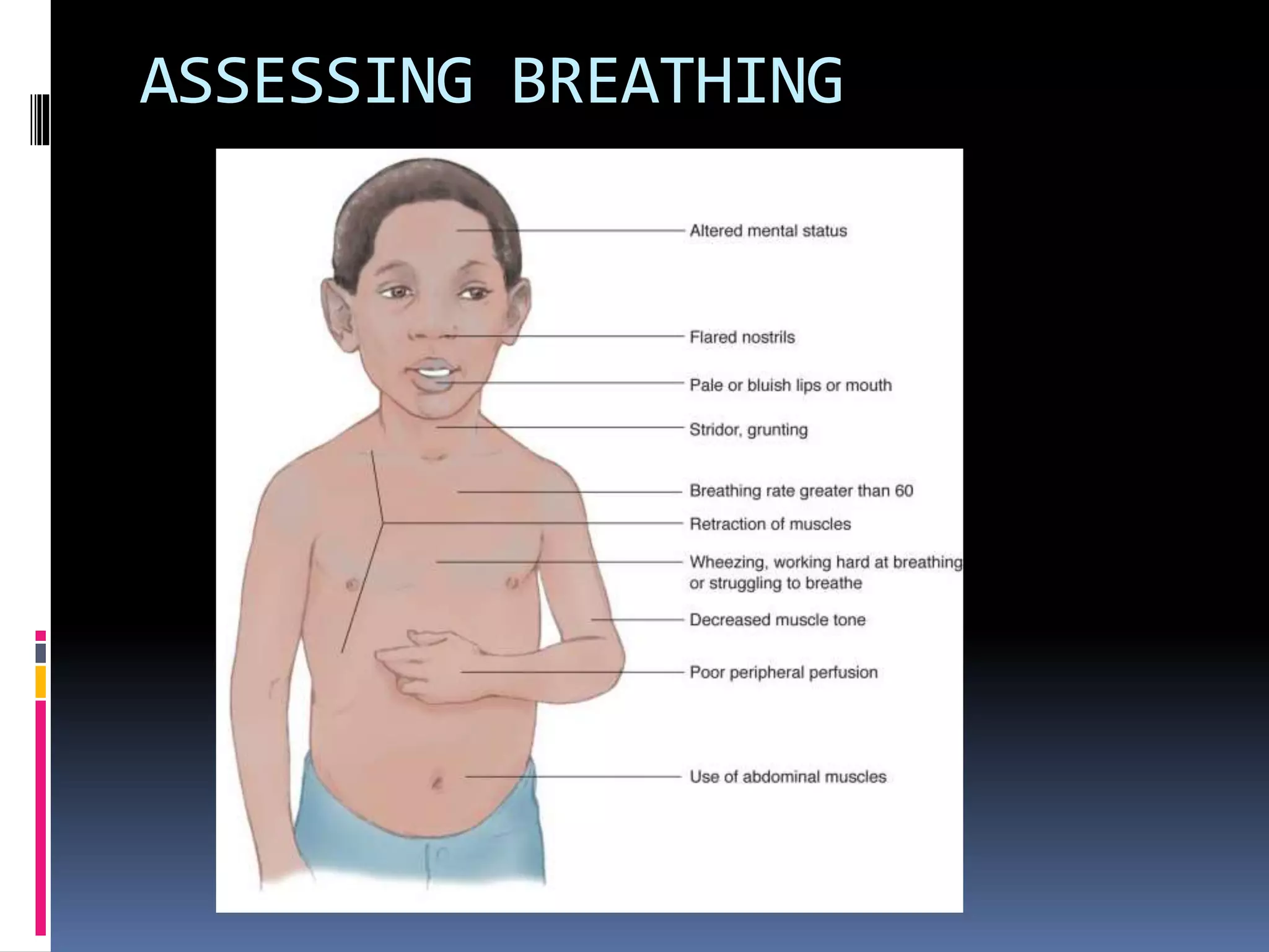 PEDIATRIC ANAPHYLAXIS | PPTX
