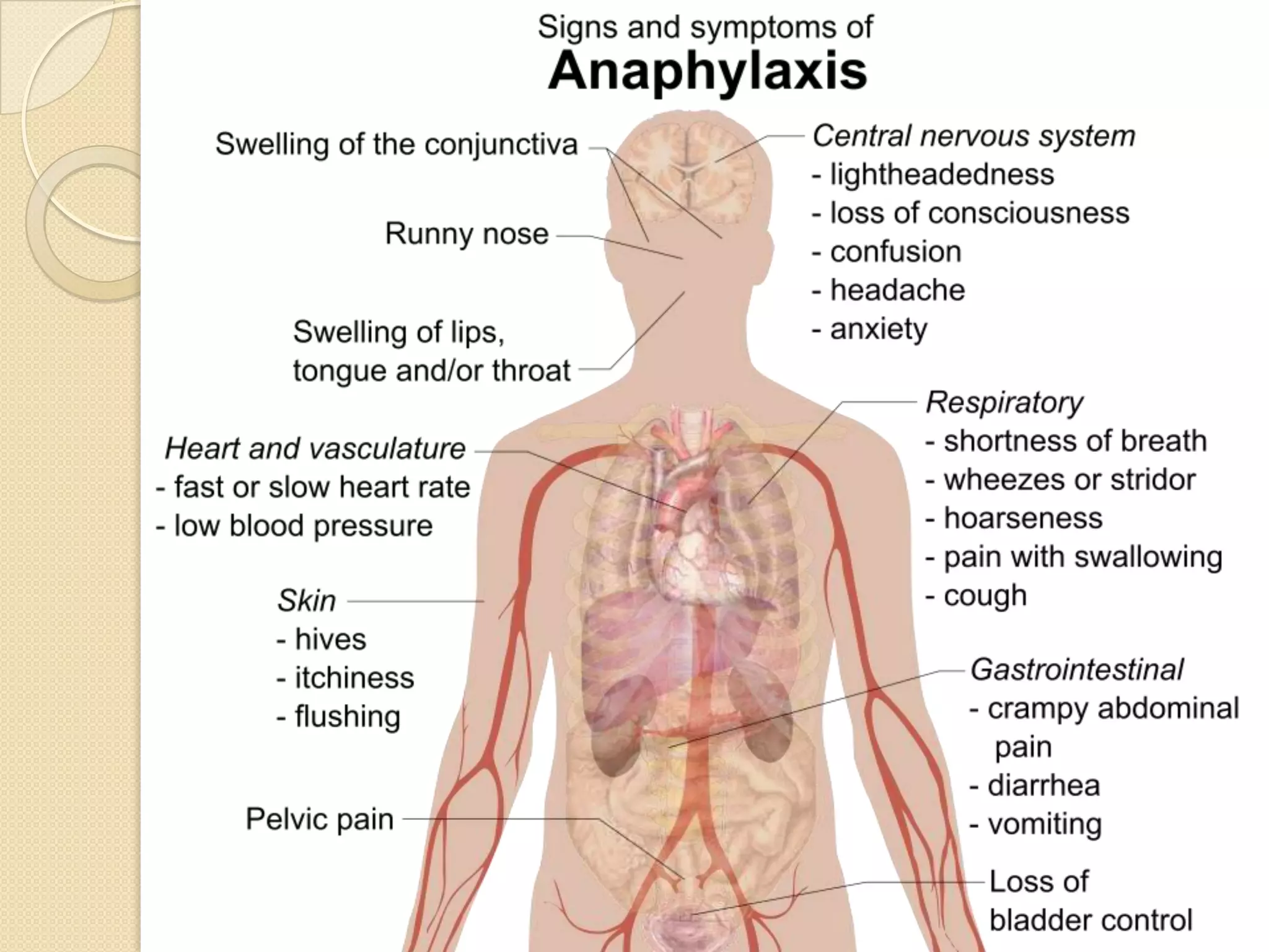 Anaphylaxis | PPTX