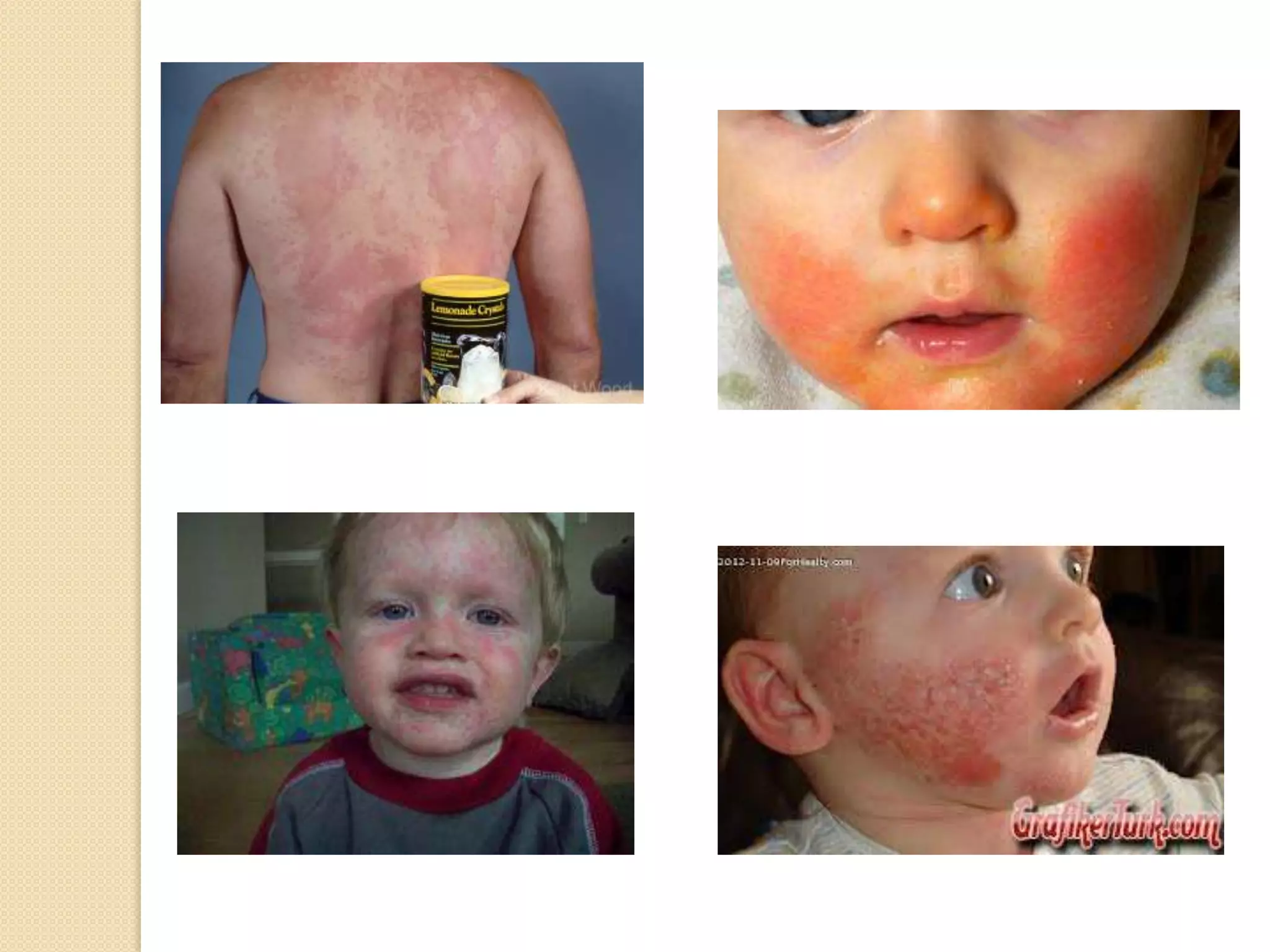Anaphylaxis | PPTX
