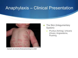 Anaphylaxis | PPTX