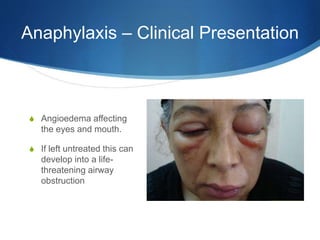 Anaphylaxis Airway