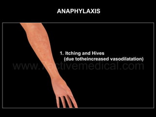 Anaphylaxis | PPTX