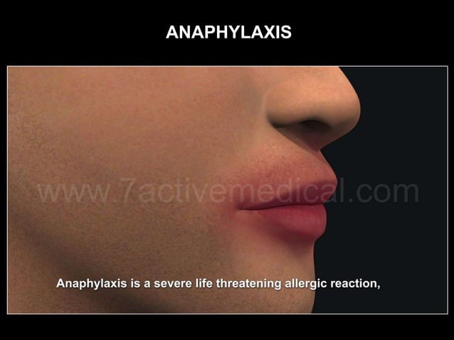 Anaphylaxis | PPT