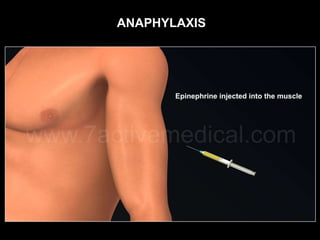 Anaphylaxis | PPT