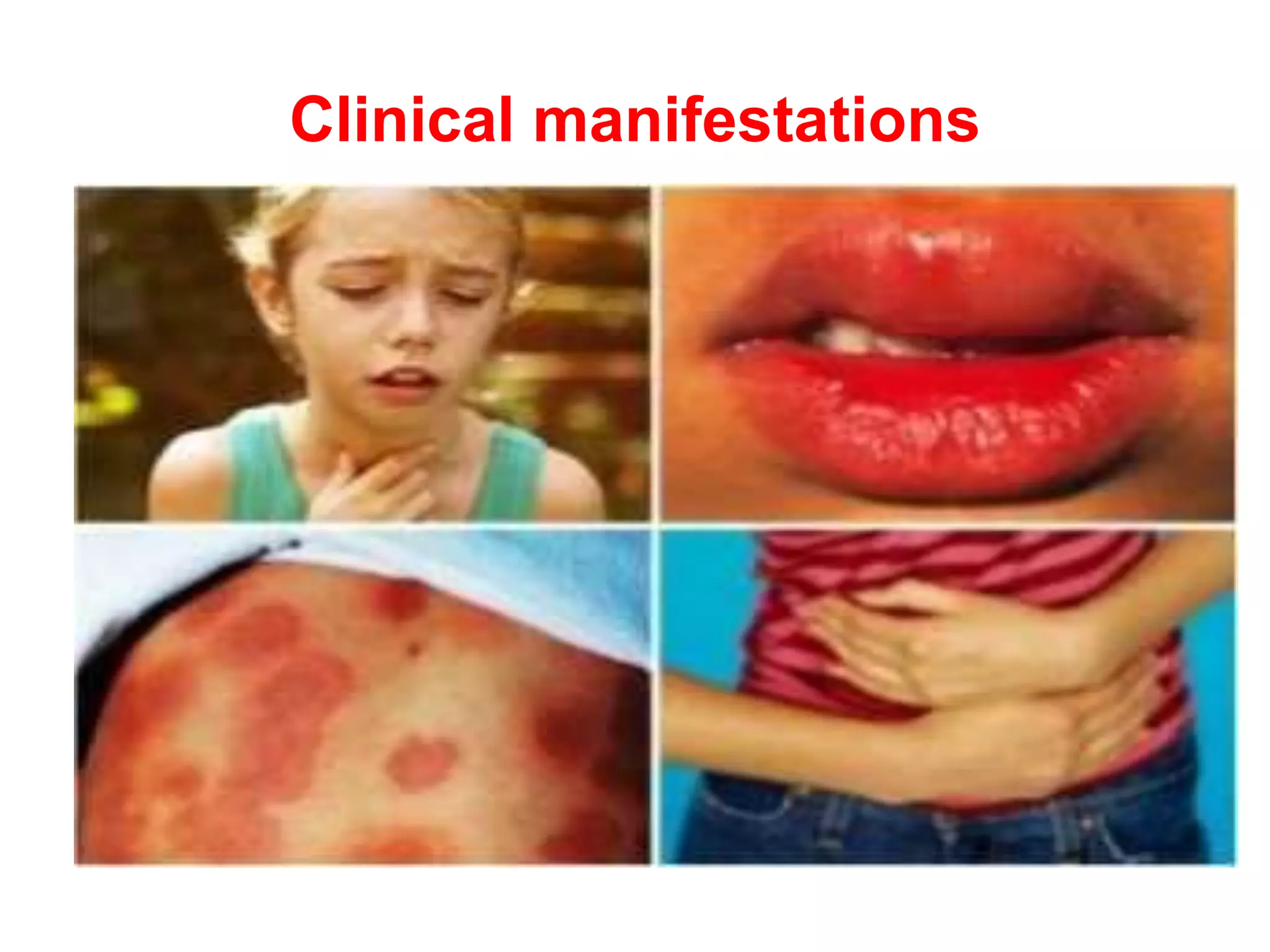 Anaphylaxis | PPTX