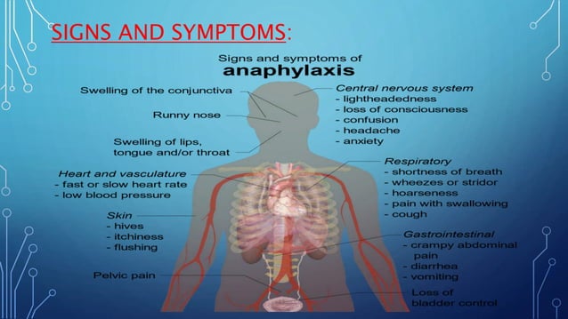 Anaphylaxis | PPT