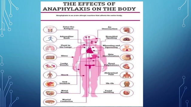 Anaphylaxis | PPT