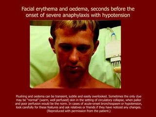 anaphylaxis.ppt