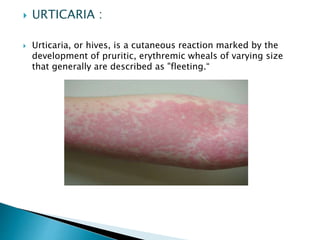 Anaphylaxis , allergic reactions | PPTX