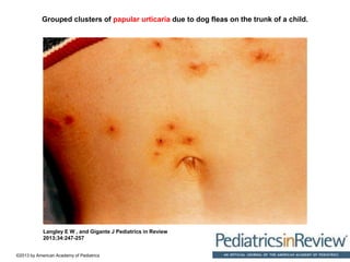 Anaphylaxis, urticaria, and angioedema | PPTX