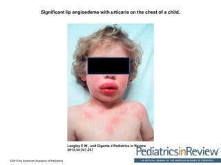 Anaphylaxis, urticaria, and angioedema | PPTX