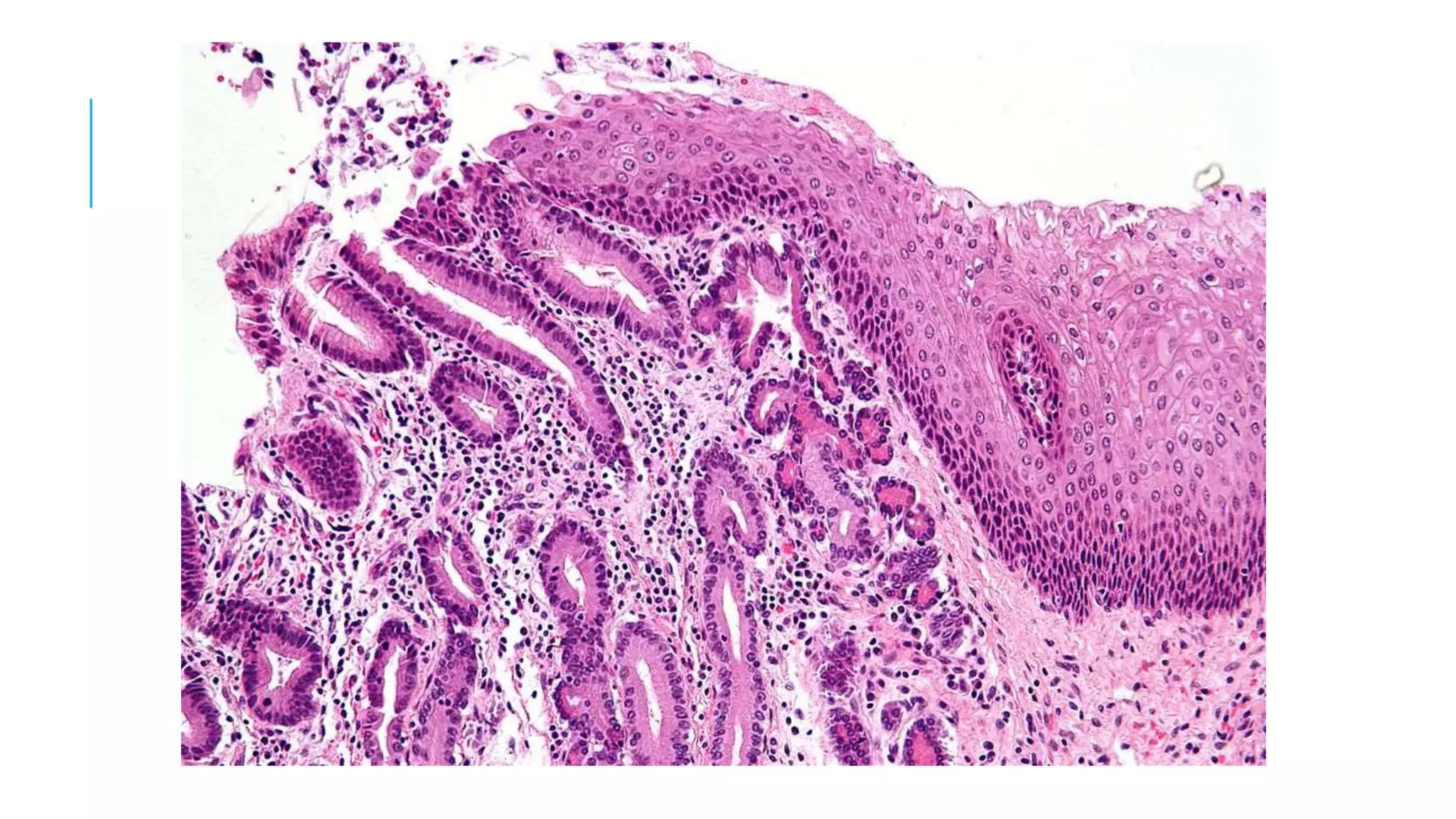 ANAPLASIA, DISPLASIA, METAPLASIA.pptx