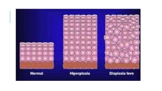 ANAPLASIA, DISPLASIA, METAPLASIA.pptx