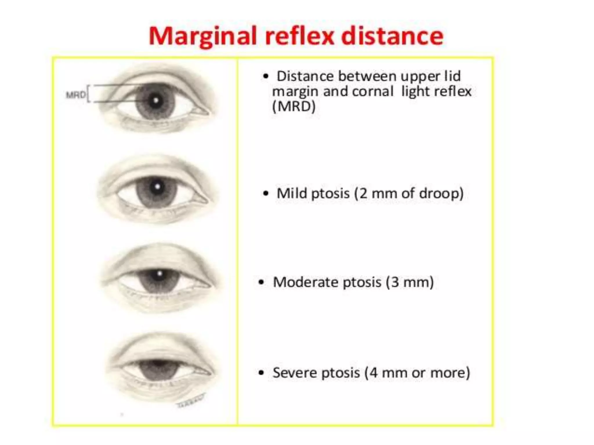 An approach to a case of ptosis | PPTX