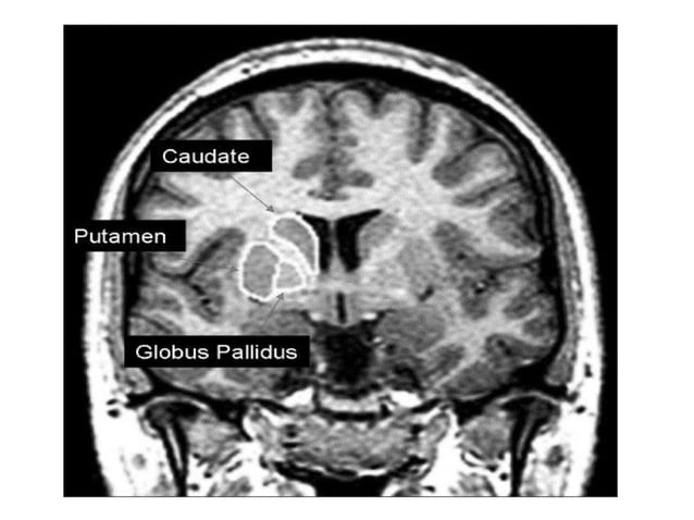 An approach to a child with abnormal movement | PPT | Brain and Nervous ...