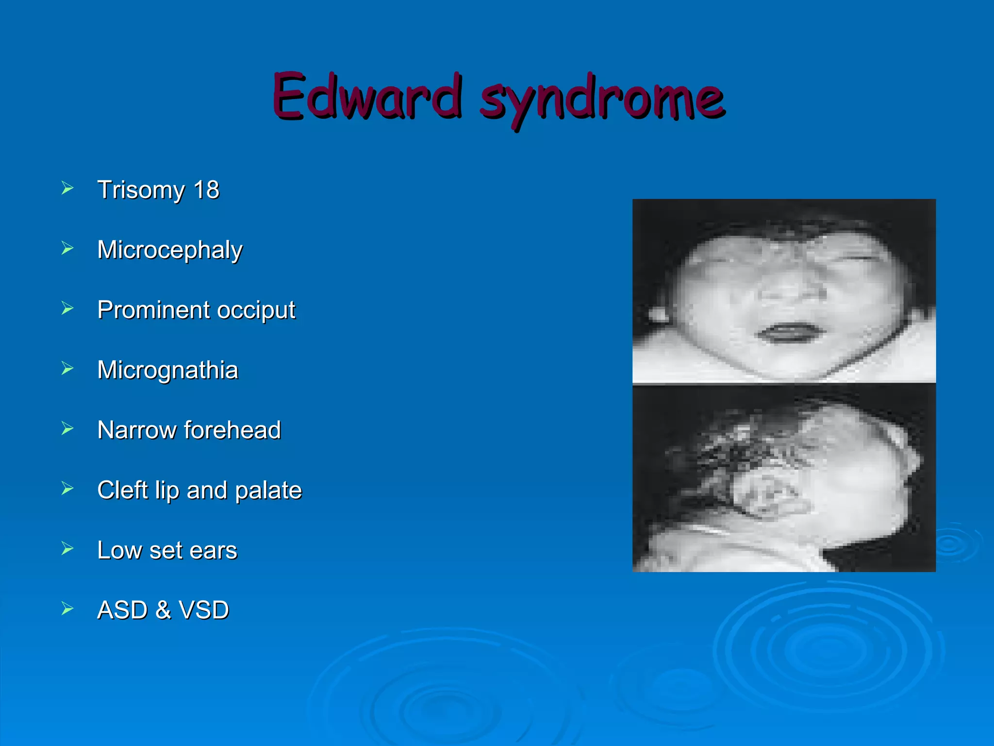 An approach to a chil with microcephaly | PPT