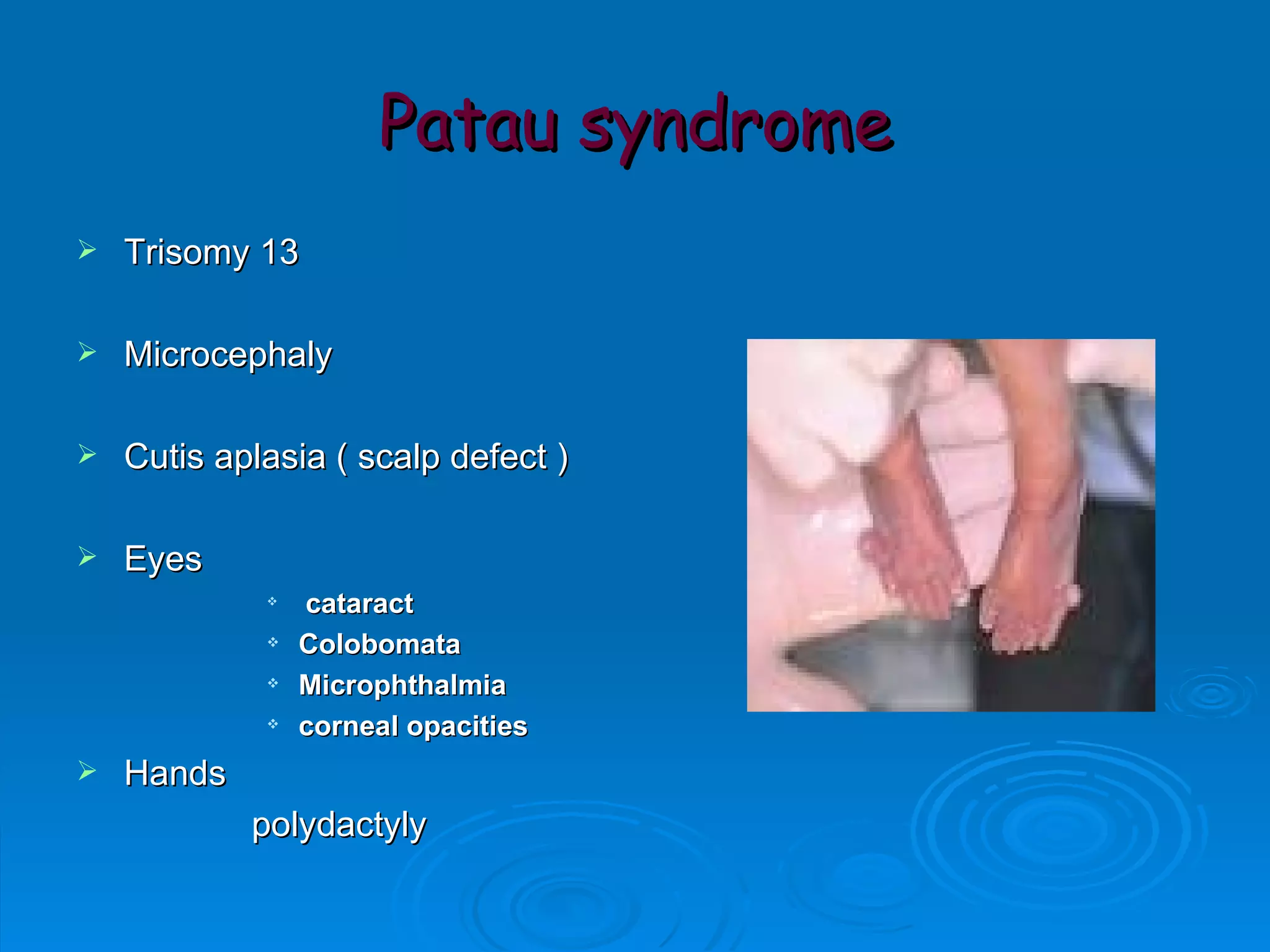 An approach to a chil with microcephaly | PPT