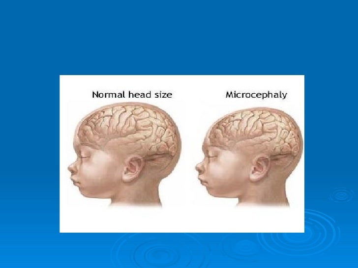 An approach to a chil with microcephaly