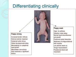 An approach to a Floppy infant - Dr Sujit | PPTX