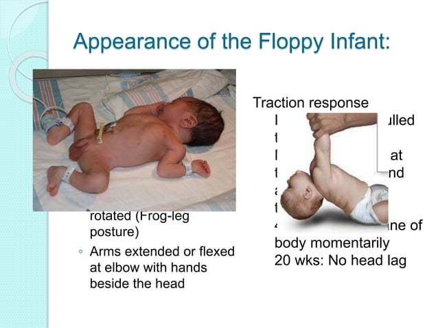An approach to a Floppy infant - Dr Sujit