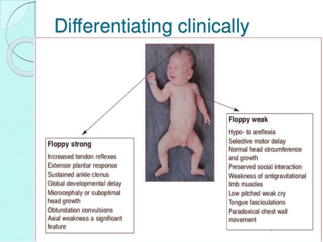 An approach to a Floppy infant - Dr Sujit