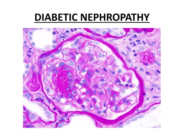 An approach to a kidney biopsy manan | PPTX