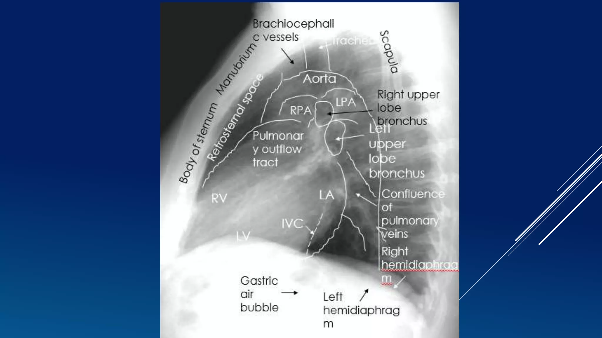 An approach to cardiac xray Dr. Muhammad Bin Zulfiqar | PPTX