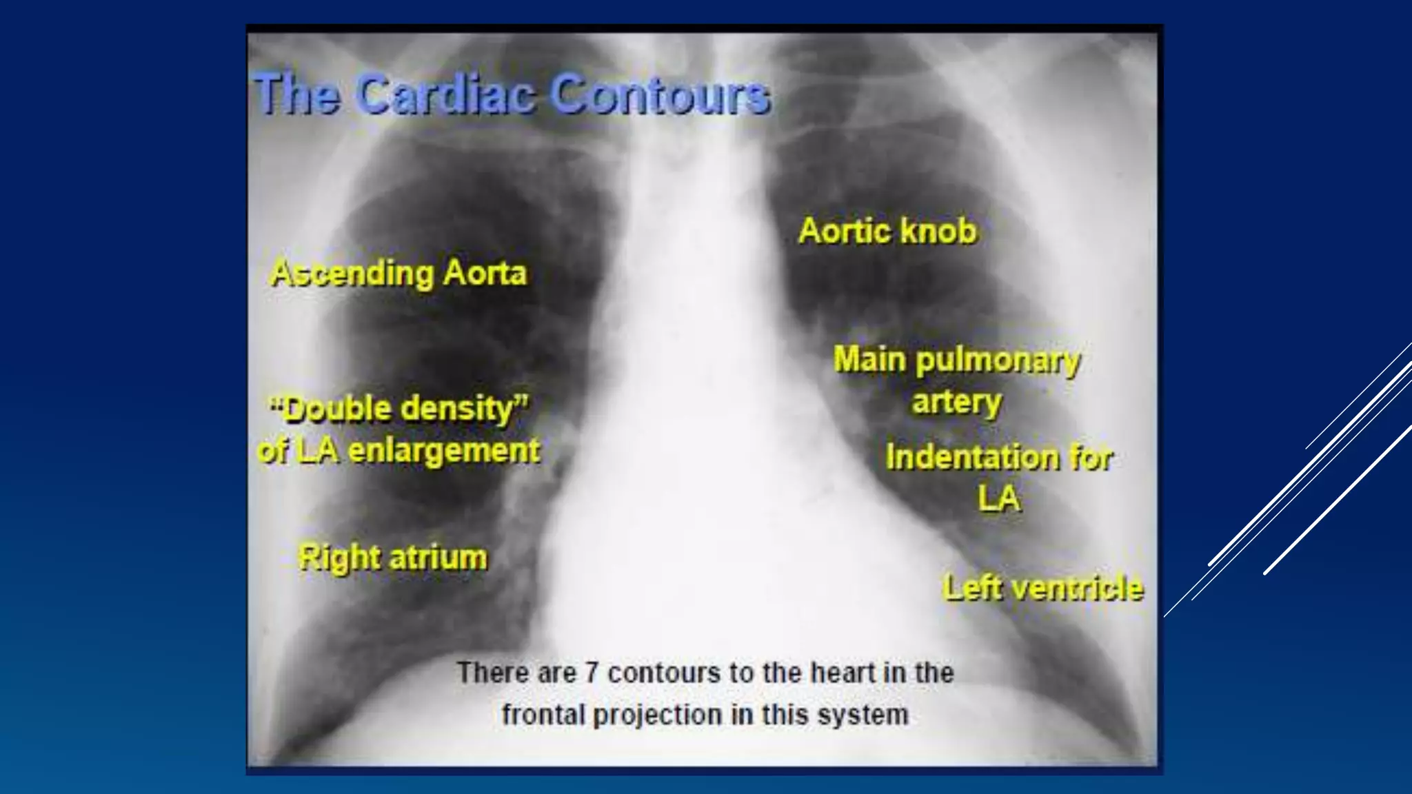 An approach to cardiac xray Dr. Muhammad Bin Zulfiqar | PPTX