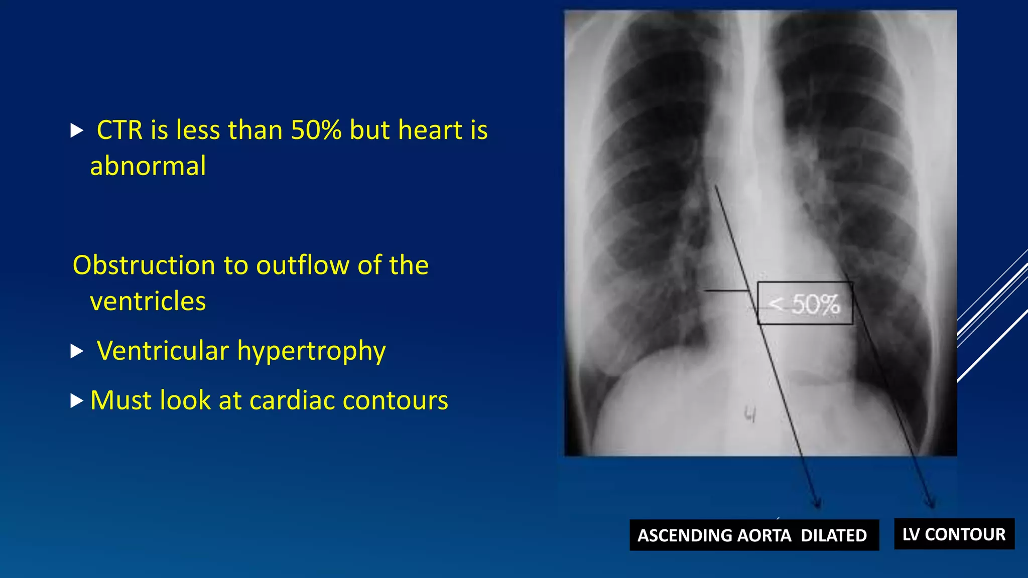 An approach to cardiac xray Dr. Muhammad Bin Zulfiqar | PPTX