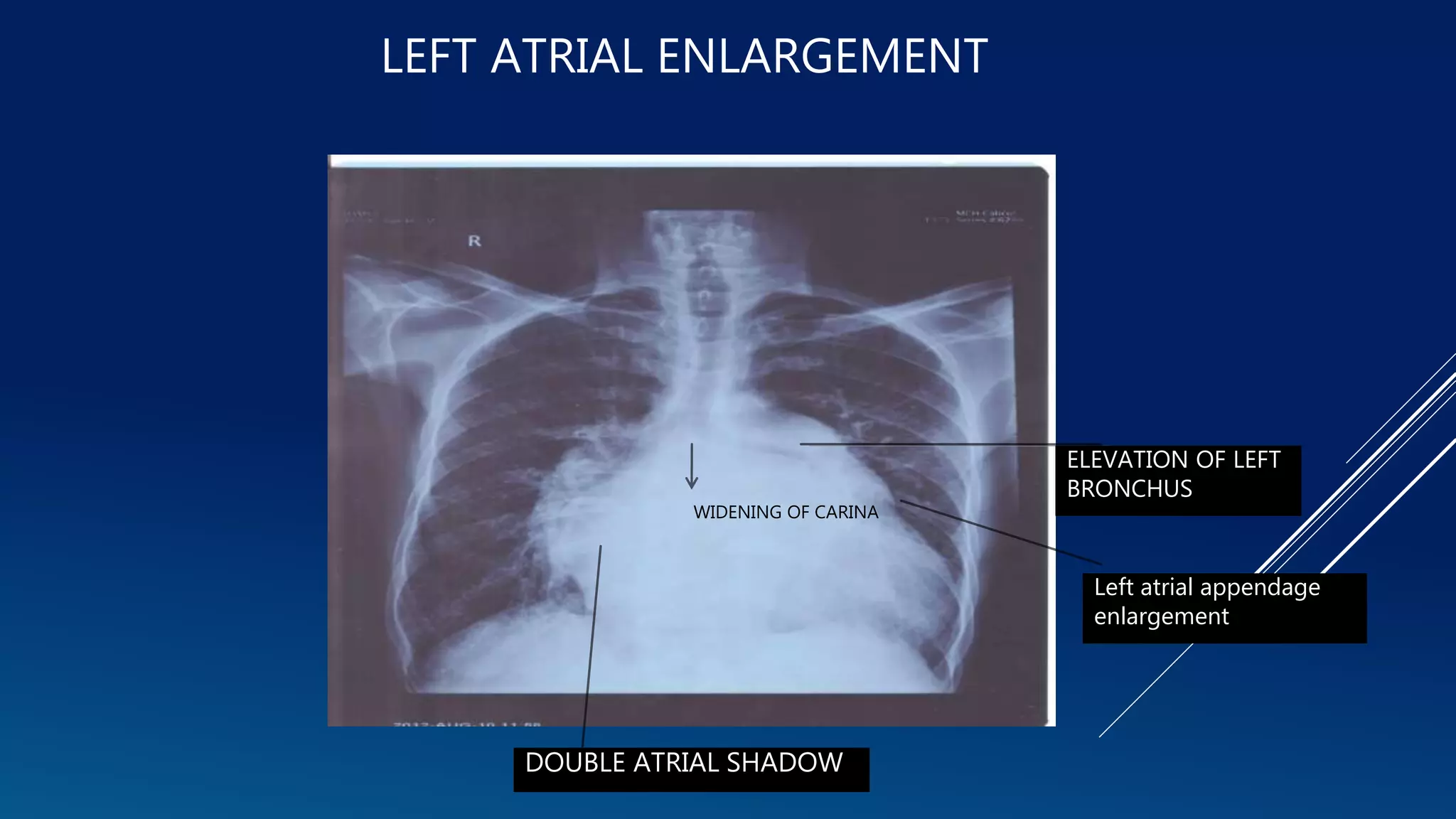 An approach to cardiac xray Dr. Muhammad Bin Zulfiqar | PPTX