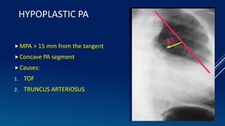 An approach to cardiac xray Dr. Muhammad Bin Zulfiqar | PPTX