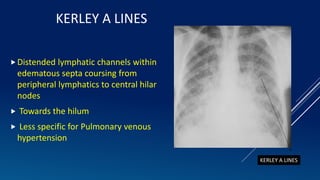 An approach to cardiac xray Dr. Muhammad Bin Zulfiqar | PPTX