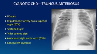 Truncus Arteriosus X Ray