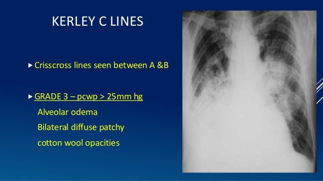 An approach to cardiac xray Dr. Muhammad Bin Zulfiqar