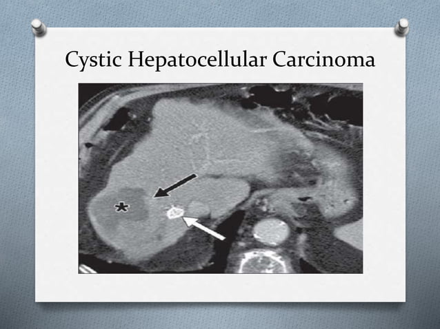 An approach to cystic hepatic lesions jk 05-aprl-2016 | PPTX