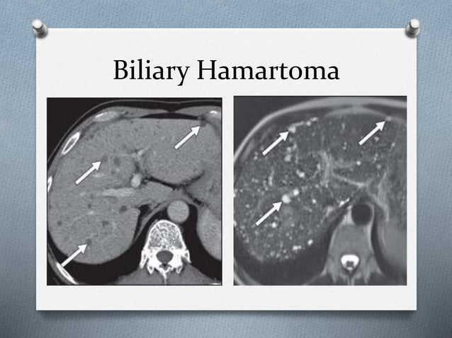An approach to cystic hepatic lesions jk 05-aprl-2016 | PPTX