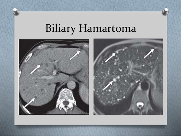 An approach to cystic hepatic lesions jk 05-aprl-2016