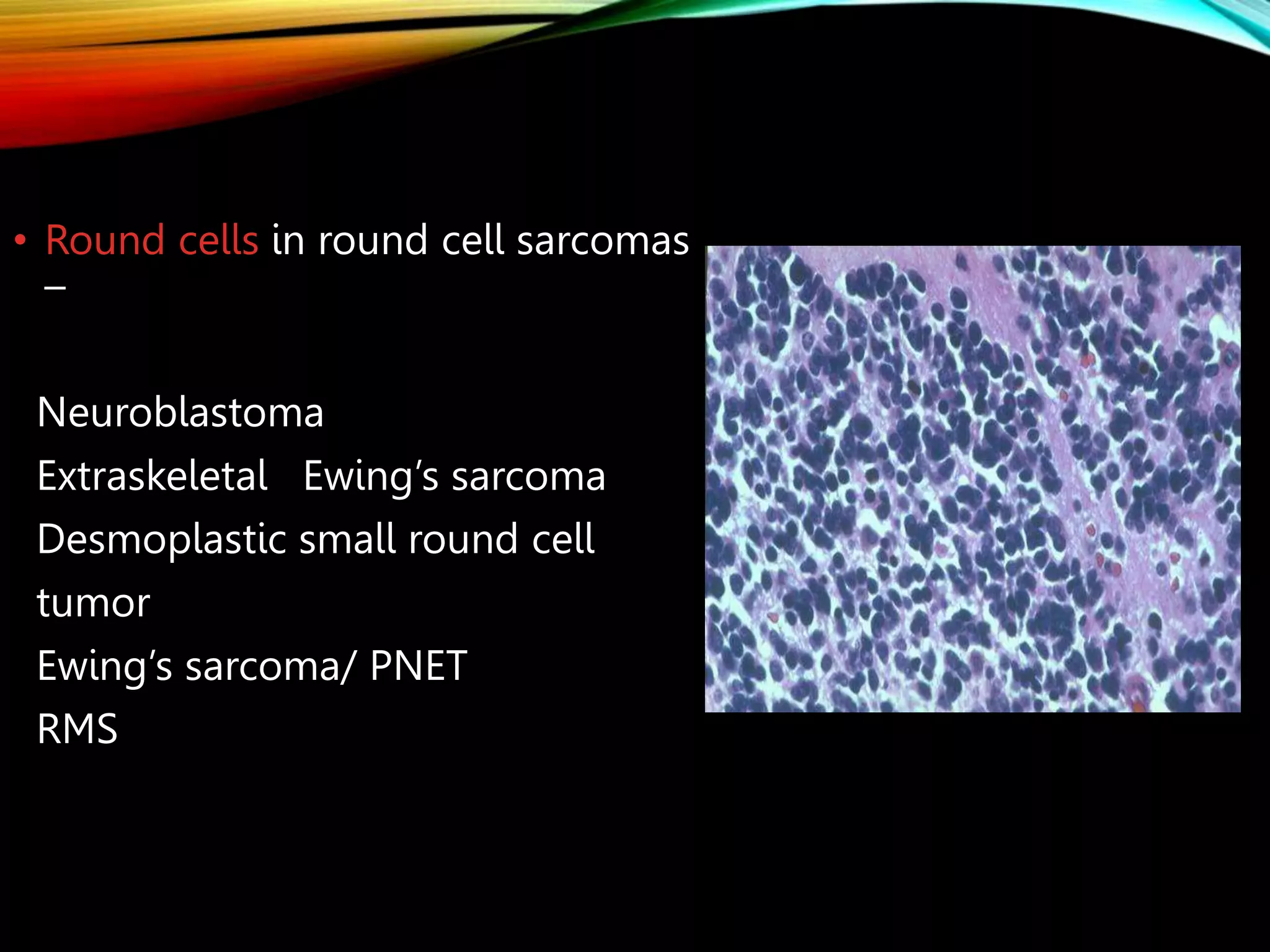 An approach to diagonosis of soft tissue sarcoma.pptx