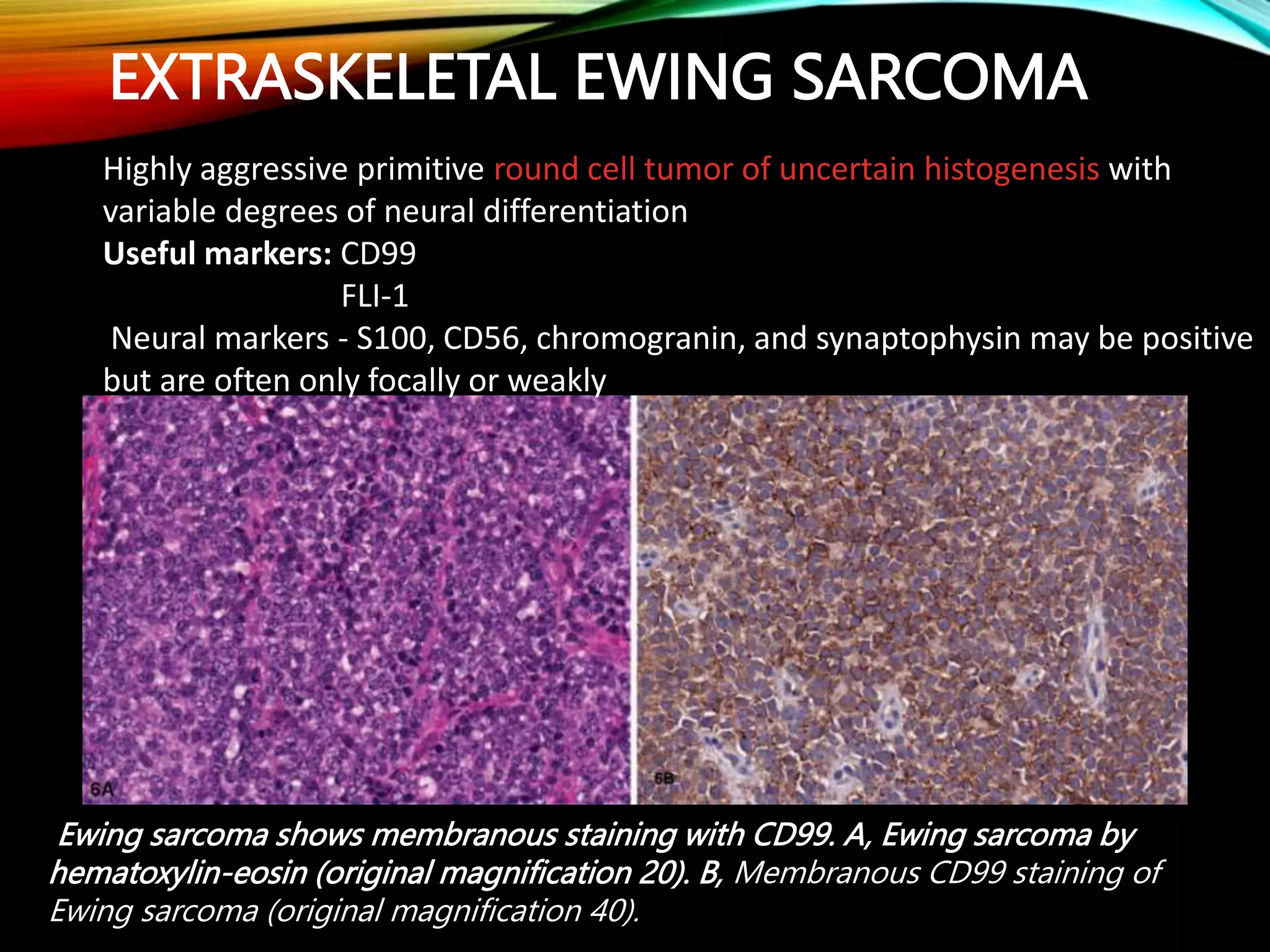 An approach to diagonosis of soft tissue sarcoma.pptx