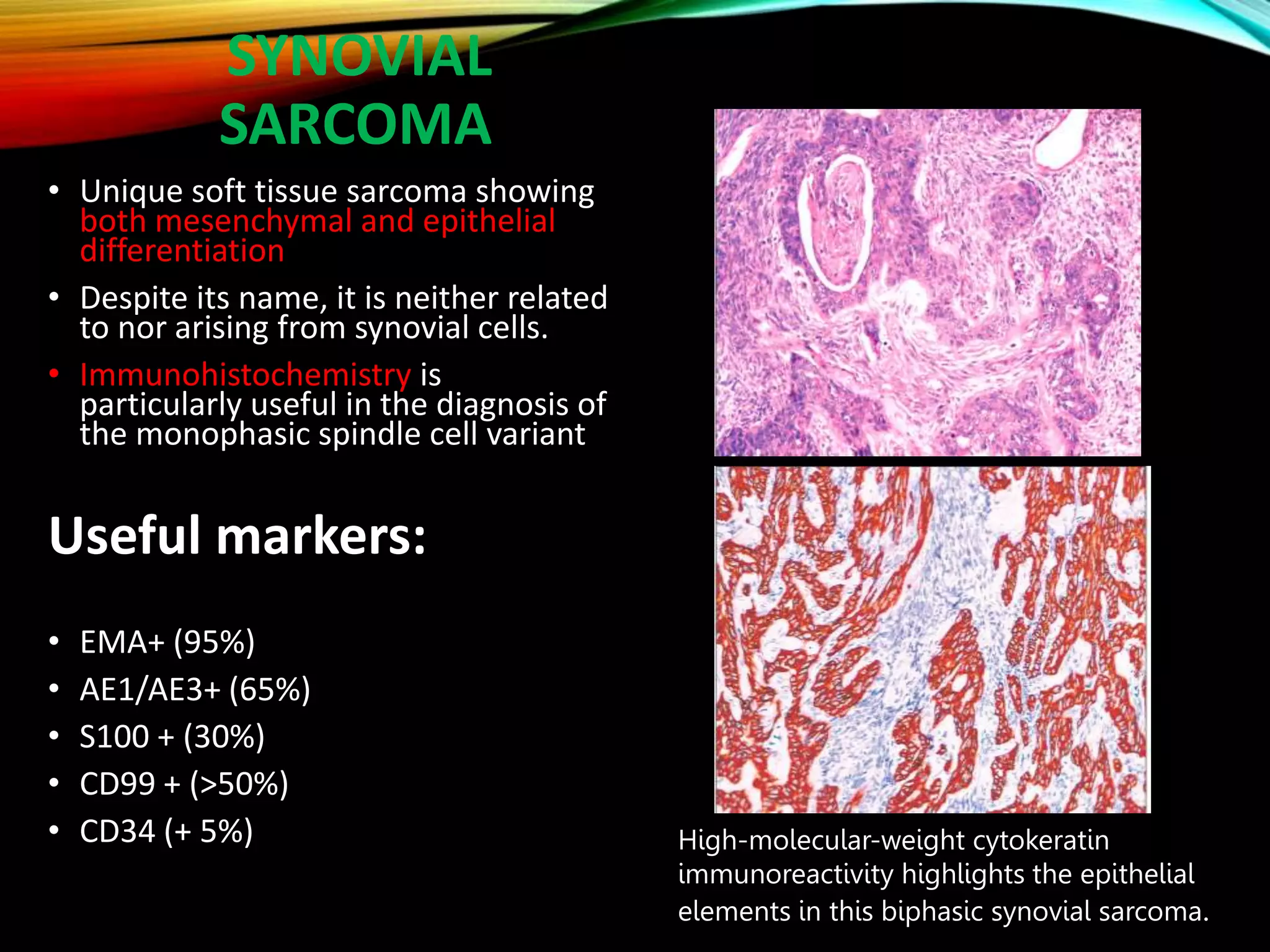 An approach to diagonosis of soft tissue sarcoma.pptx