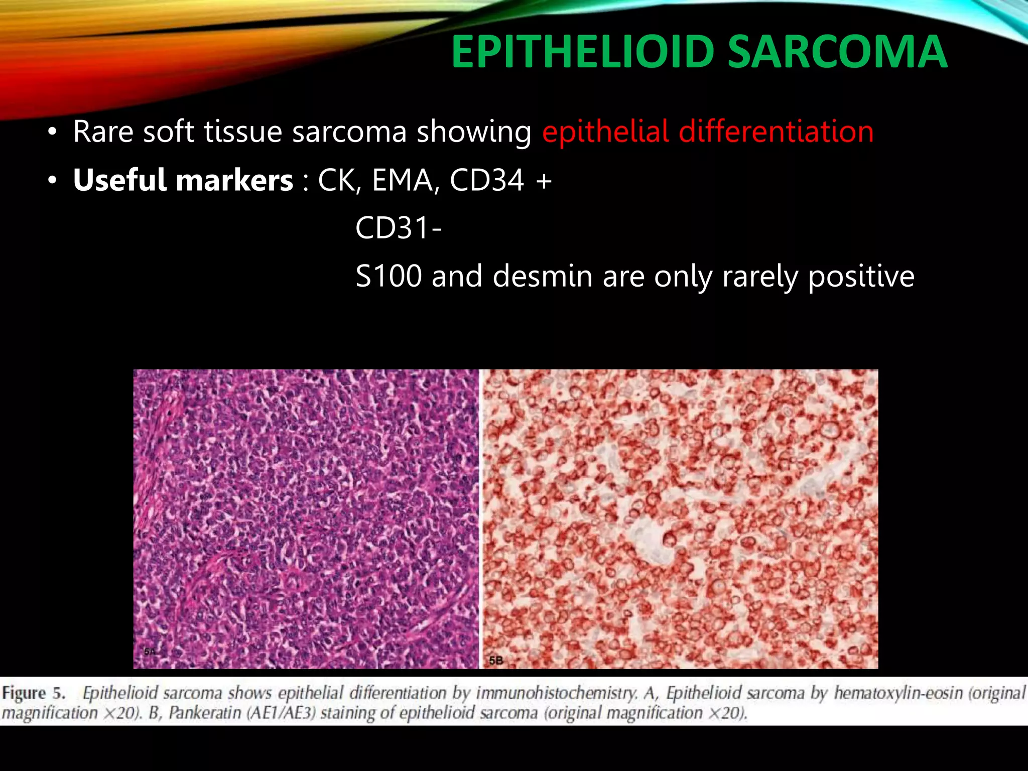 An approach to diagonosis of soft tissue sarcoma.pptx