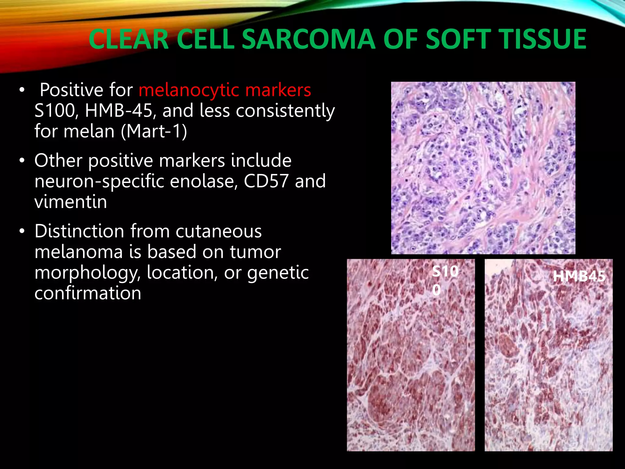 An approach to diagonosis of soft tissue sarcoma.pptx