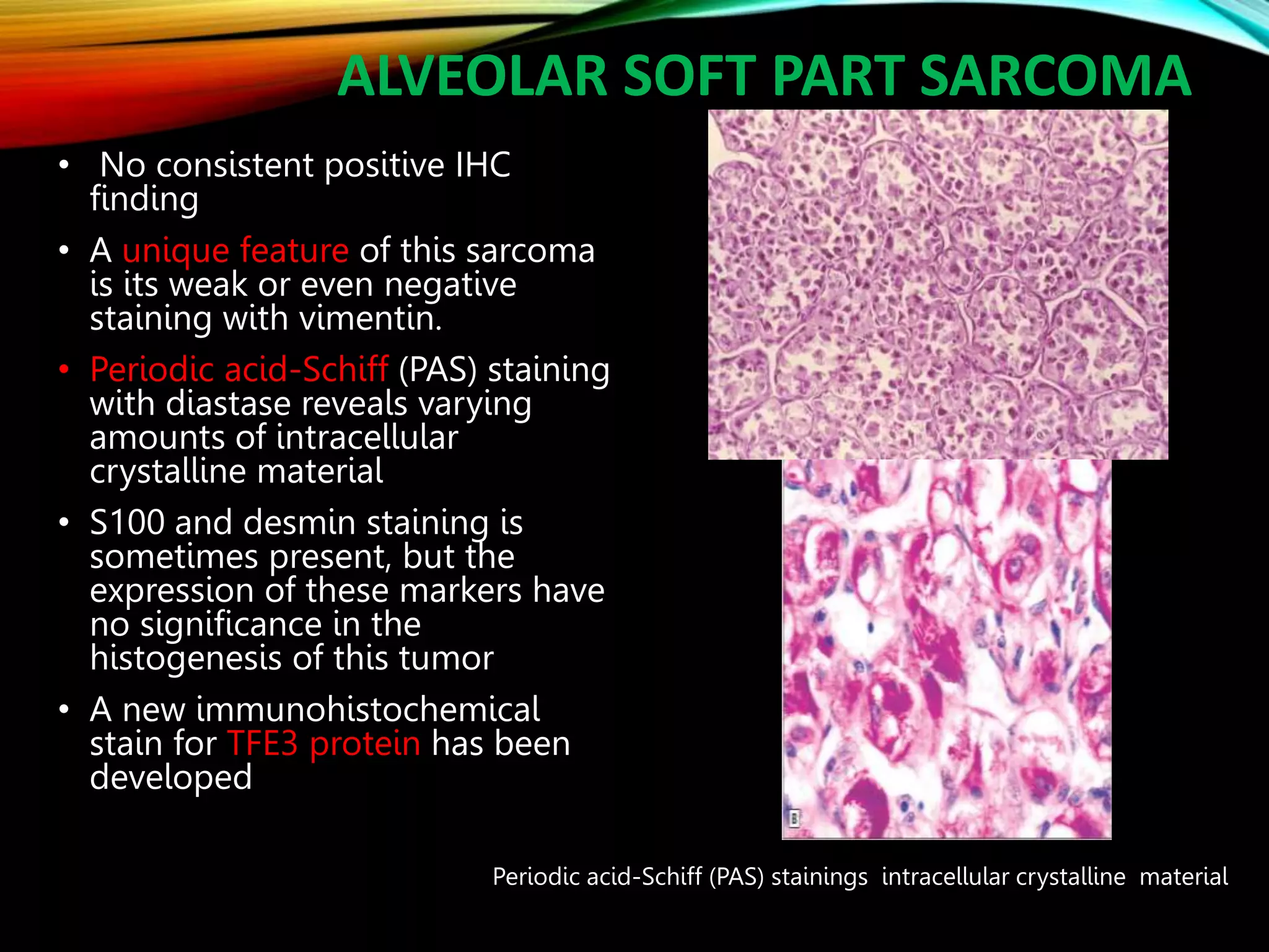 An approach to diagonosis of soft tissue sarcoma.pptx