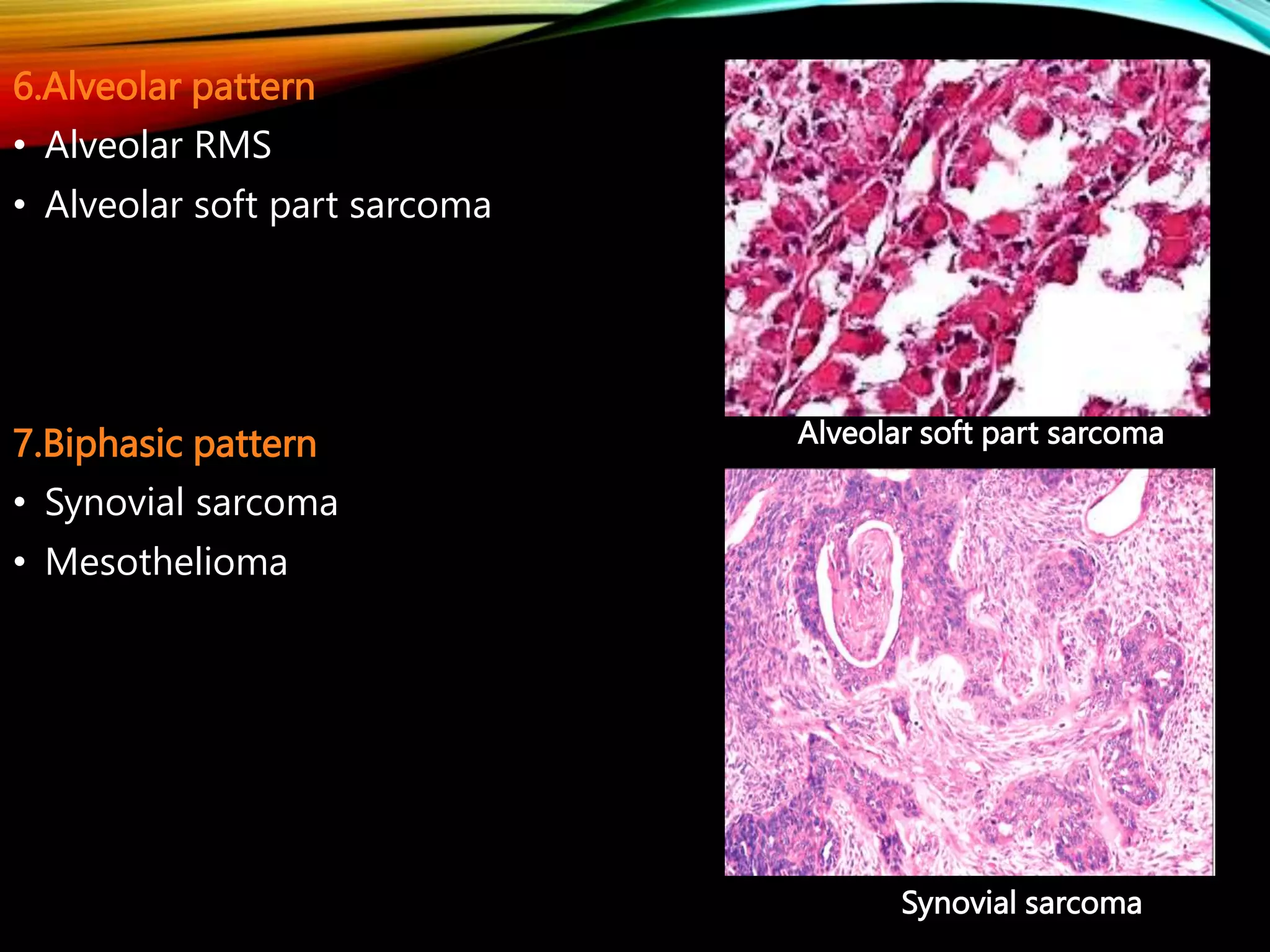 An approach to diagonosis of soft tissue sarcoma.pptx