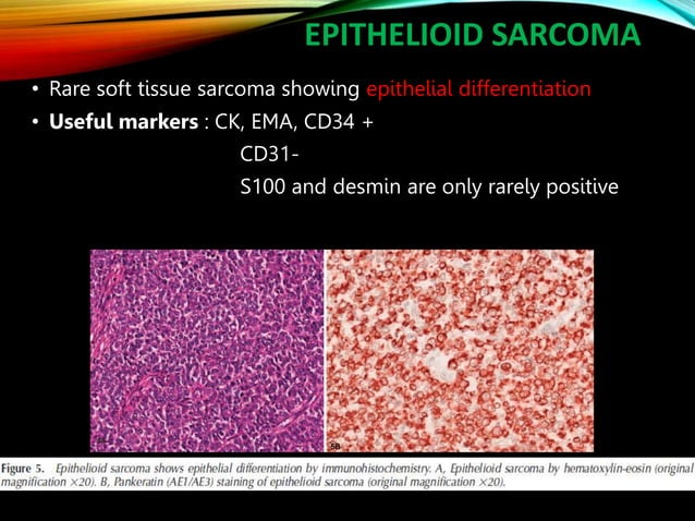 An approach to diagonosis of soft tissue sarcoma.pptx