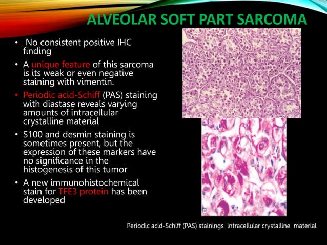 An approach to diagonosis of soft tissue sarcoma.pptx