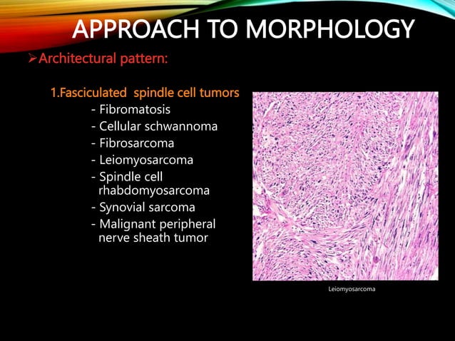 An approach to diagonosis of soft tissue sarcoma.pptx